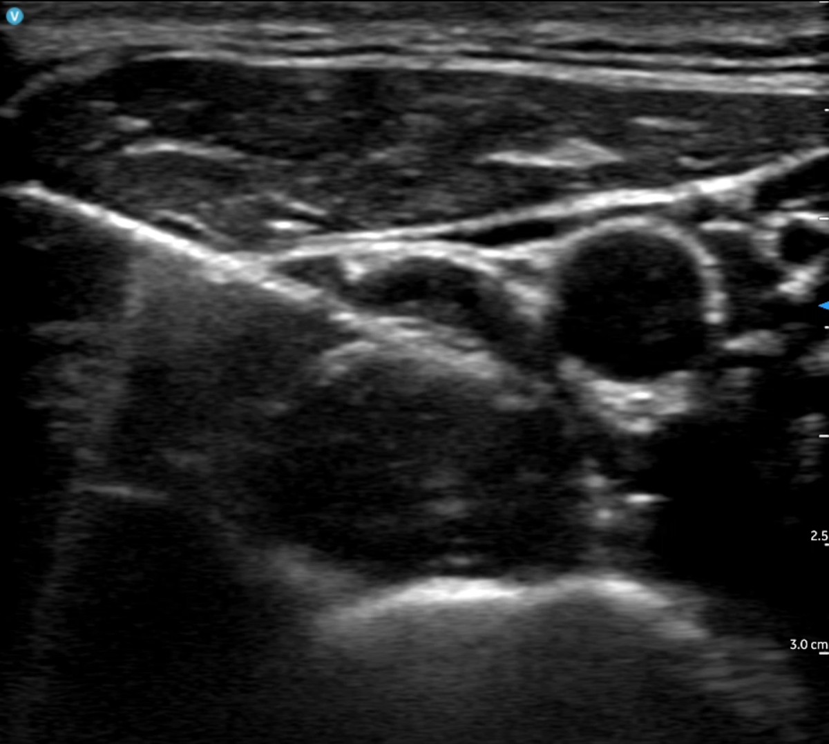 Navigating the Intricacies of Stellate Ganglion Block in the Bay Area ...